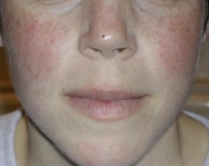 SLE Malar Rash : USMLE / Internal Medicine ABIM Board Exam Review Blog